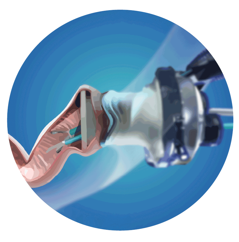 Trans Anal Minimally Invasive Surgery San Bernardino County Hospital
